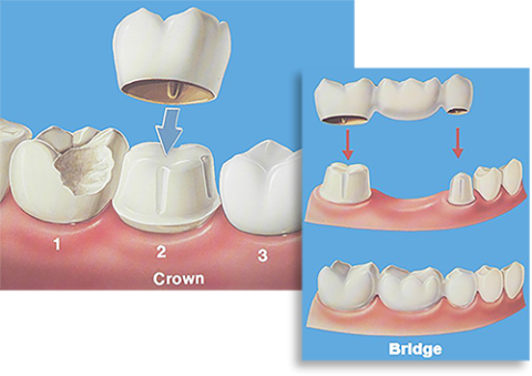 Crowns & Bridges Doncaster East | Sapphire Dentistry